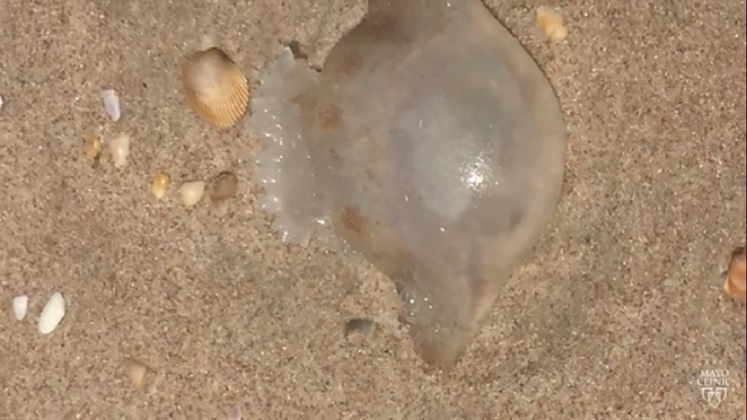 What To Do If You Are Stung By A Jellyfish (Video) - South Florida Reporter